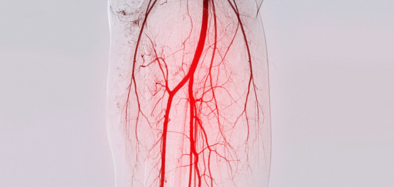 Anger & Blood Vessel Function | Advanced Cardiovascular Center